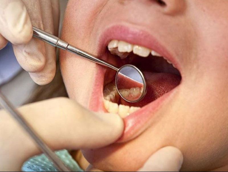 Эрт илрүүлэгт хамрагдсан нэгдүгээр ангийн сурагчдын 78 5 хувь нь шүдний өвчлөлтэй гарчээ